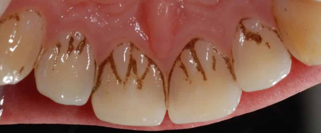 Macchie nere sui denti del tuo bimbo? Si tratta delle Black Stain ...