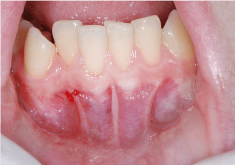 Laser dentale: perché è utile per togliere il frenulo - Studio ...