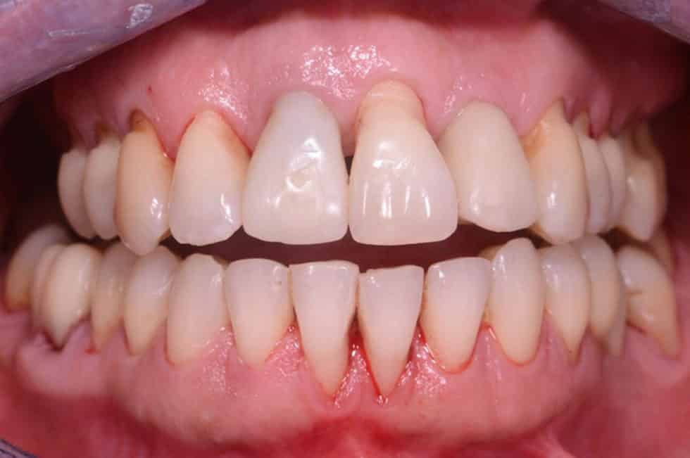 Non trascurare le tue gengive! | Dott.Maini, Rovereto